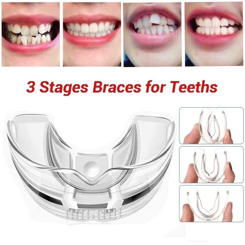 Jual TINGXING Alat Perapi Gigi Dewasa Clear Aligner Teeth Braces